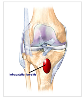 Infrapatellar Bursitis Natural Treatment | OSMO Patch UK
