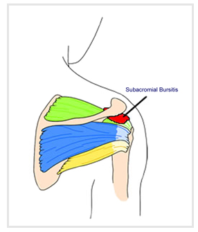Subdeltoid Bursitis Osteopathic Treatment Of Shoulder Bursitis
