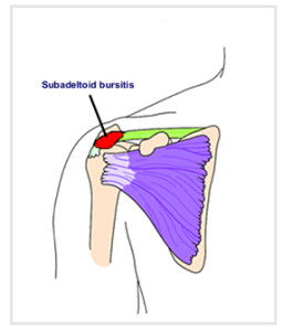 Subdeltoid Bursitis Natural Treatment | OSMO Patch UK