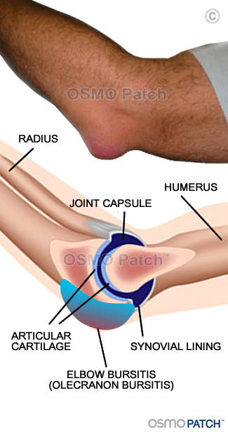 Olecranon Bursitis What Does Elbow Bursitis Look & Feel Like?